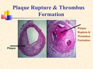 Acute coronary syndromes | PPT