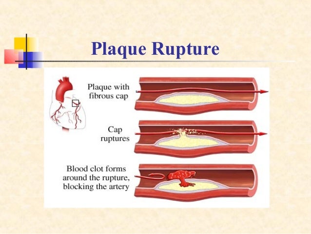 Acute coronary syndromes
