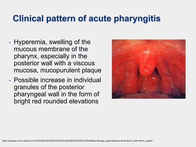 Acute-diseases-of-pharynx_Acute-diseases-of-pharynx | PPT