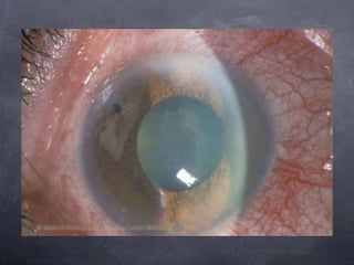 acute-eye-conditions-glaucoma.ppt