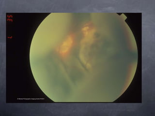 acute-eye-conditions-glaucoma.ppt