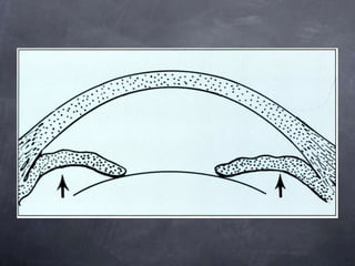 acute-eye-conditions-glaucoma.ppt