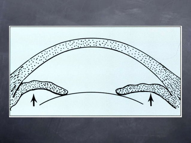 Acute Eye Conditions Glaucoma Ppt