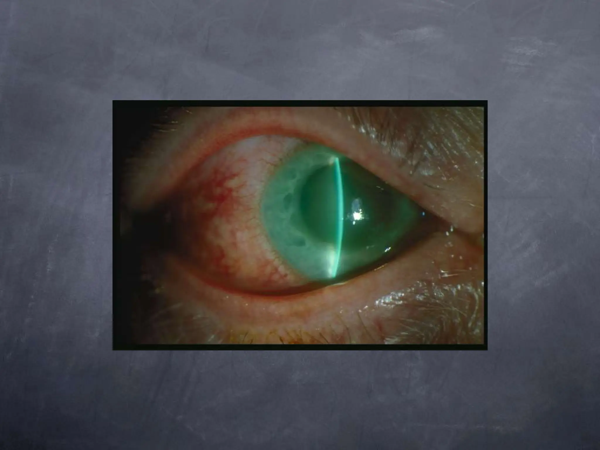 acute-eye-conditions-glaucoma.ppt
