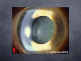 acute-eye-conditions-glaucoma.ppt