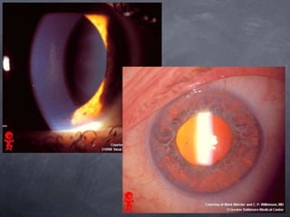 acute-eye-conditions-glaucoma.ppt