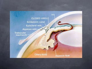 acute-eye-conditions-glaucoma.ppt