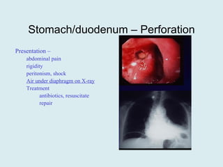 Acute Gastrointestinal Emergencies | PPT