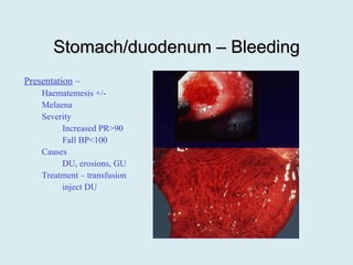 Acute Gastrointestinal Emergencies | PPT