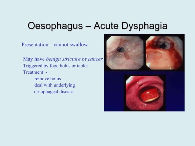 Acute Gastrointestinal Emergencies | PPT | Digestive Disorders ...