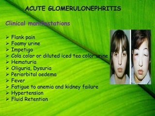Nursing note on Acute-Glomerulonephritis.pdf