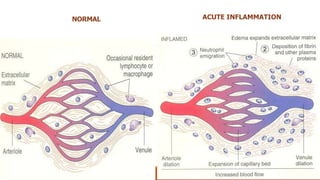 Chapter 2 Acute-inflammation general pathology | PPTX