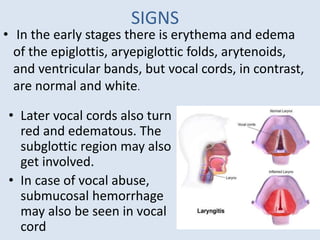 Acute inflammations-of-larynx | PPTX | Ear, Nose and Throat Conditions ...