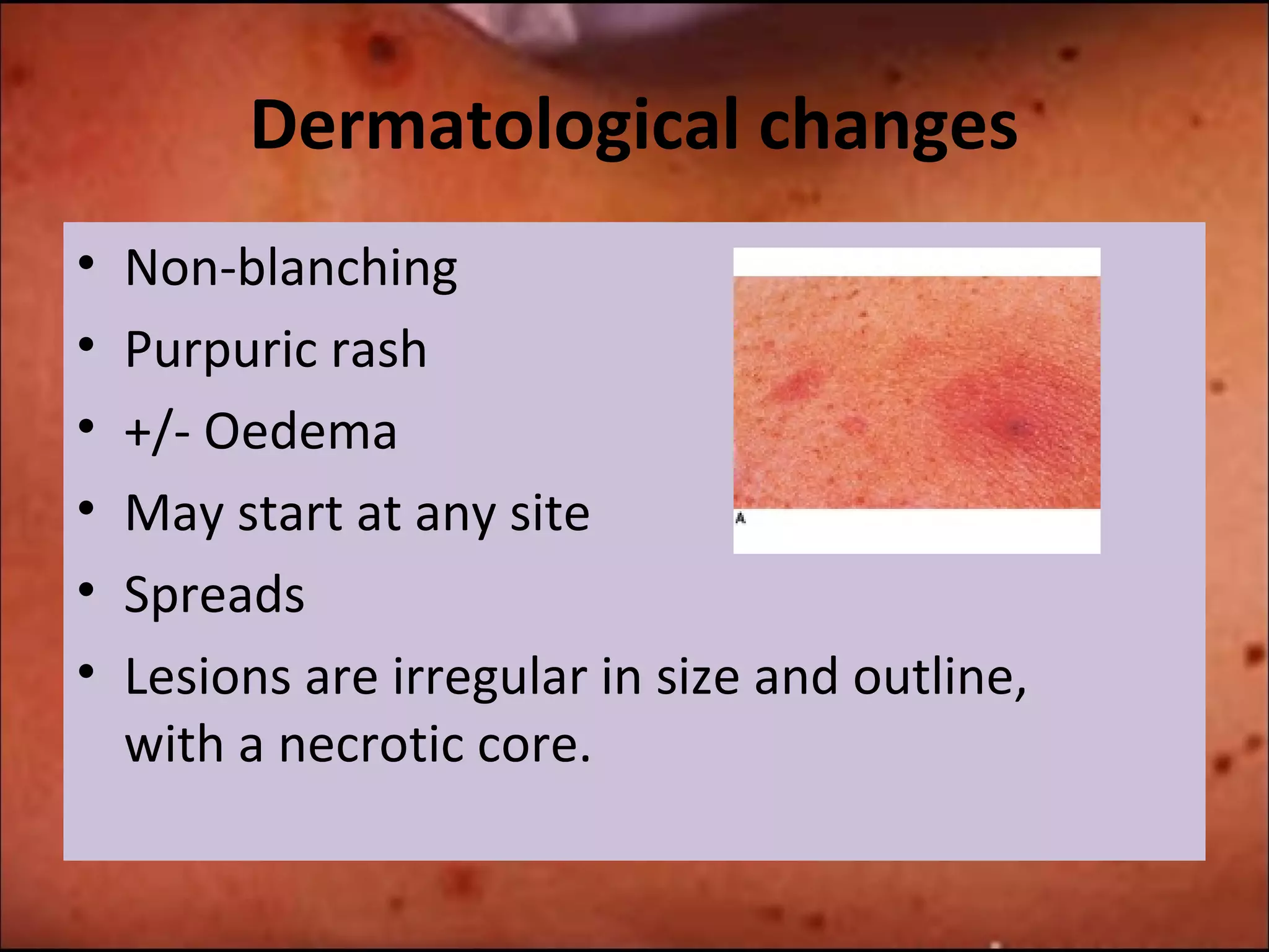 Acute Meningococcaemia | PPT