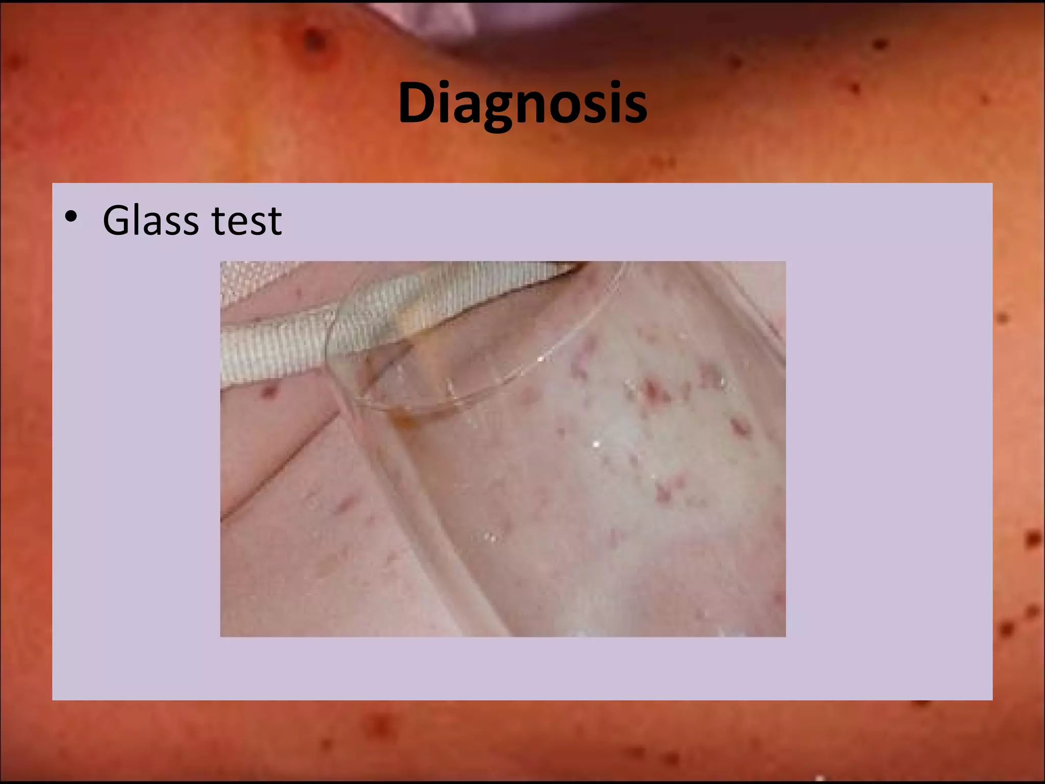 Acute Meningococcaemia | PPT
