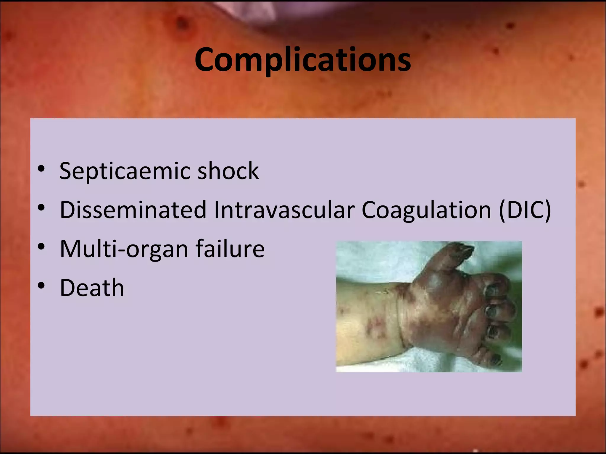 Acute Meningococcaemia | PPT
