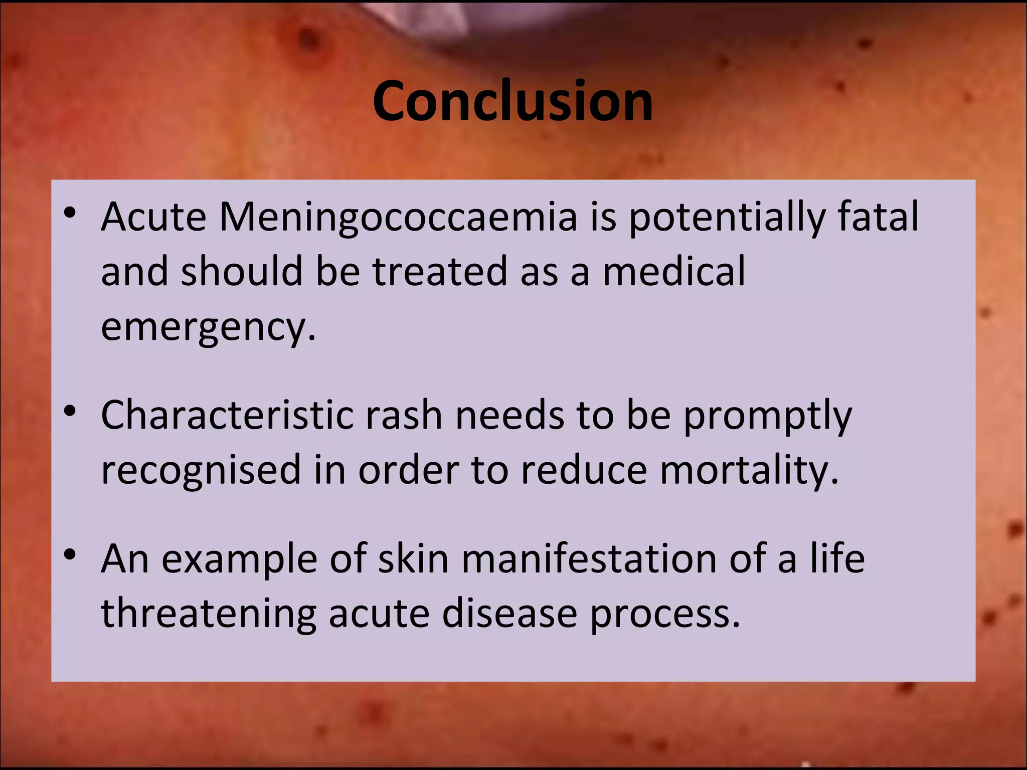 Acute Meningococcaemia | PPT