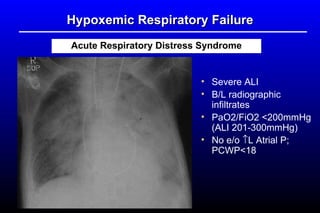 Acute Resp Failure Cyndy Kin | PPT