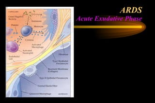 Acute Respiratory Distress Syndrome | PPT | Lung and Respiratory Health ...