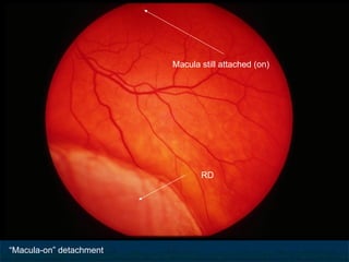 Acute-Visual-Loss-Emergency-Room-Perspective.ppt