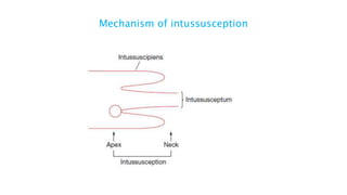 Acute abdomen in children | PPTX