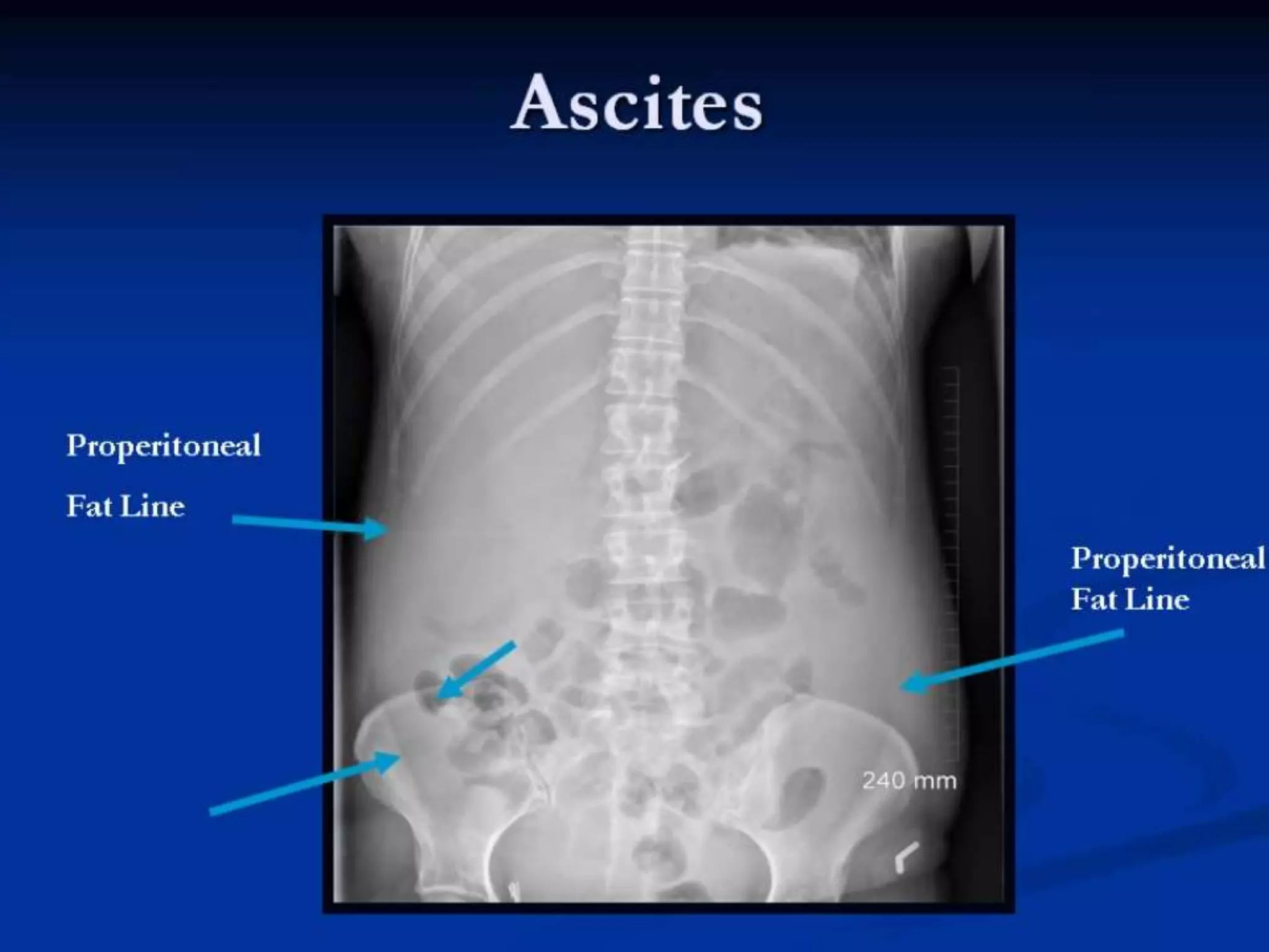 Imaging of Acute Abdomen | PPTX