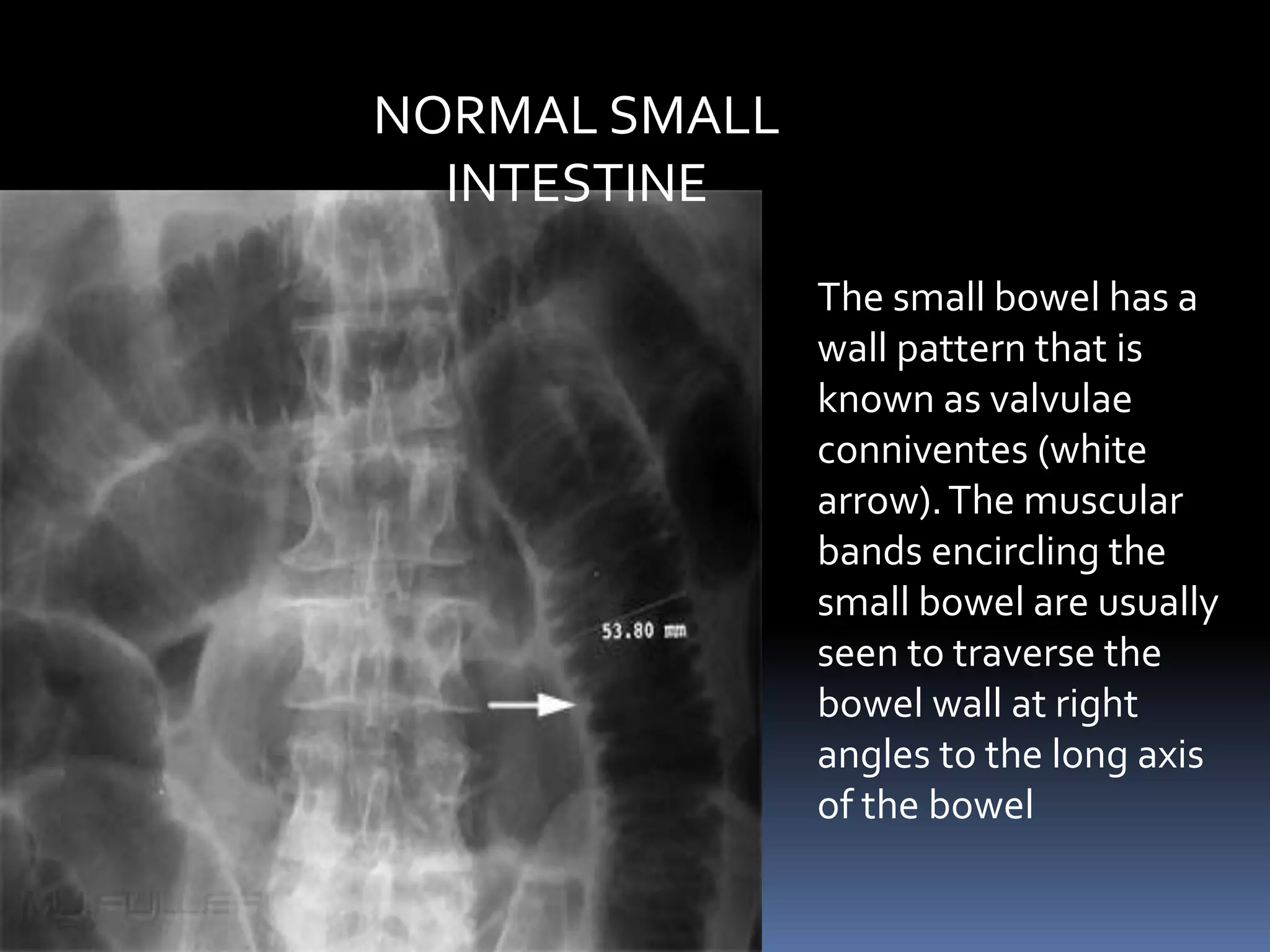 Imaging of Acute Abdomen | PPTX