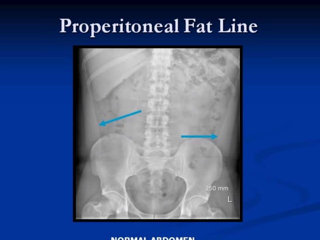 Imaging of Acute Abdomen | PPTX | Digestive Disorders | Diseases and ...