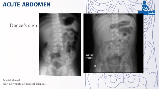 Acute abdomen