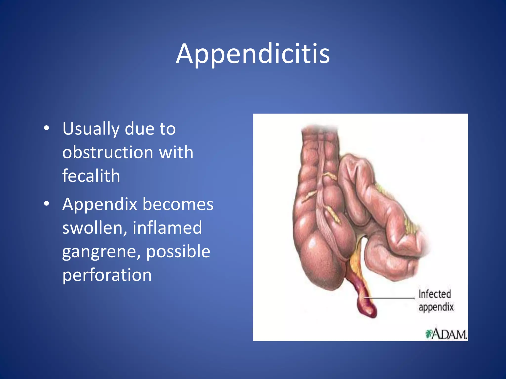 Acute abdomen | PPTX