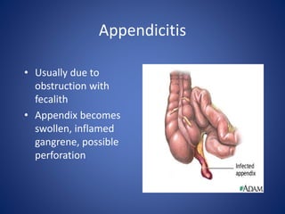 Acute abdomen | PPTX