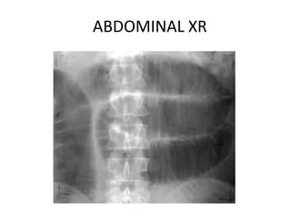 Acute abdomen | PPTX