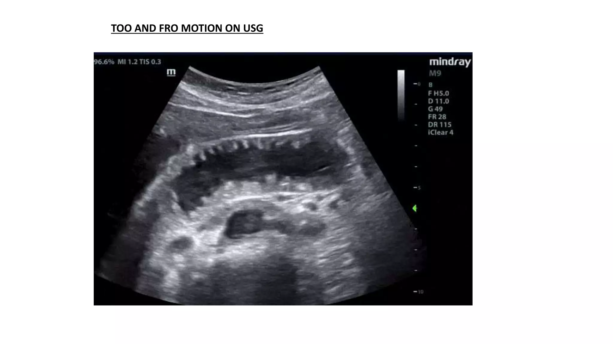 Acute abdomen | PPTX