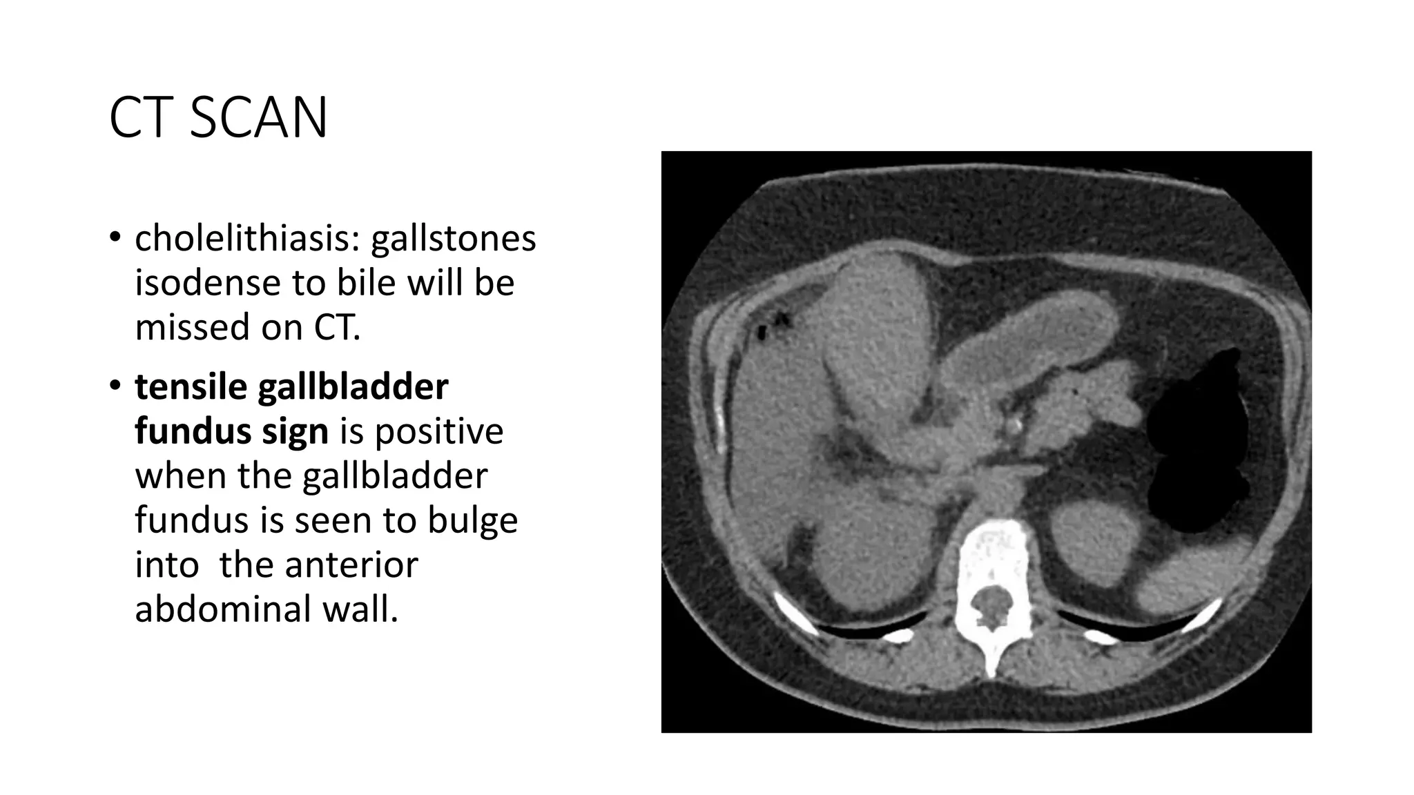 Acute abdomen | PPTX