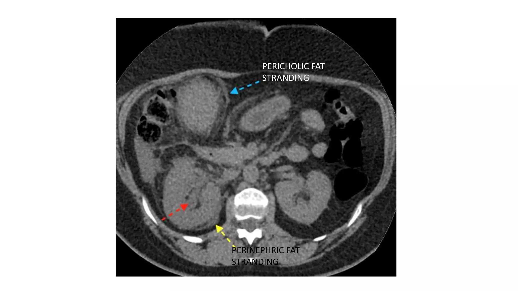 Acute abdomen | PPTX