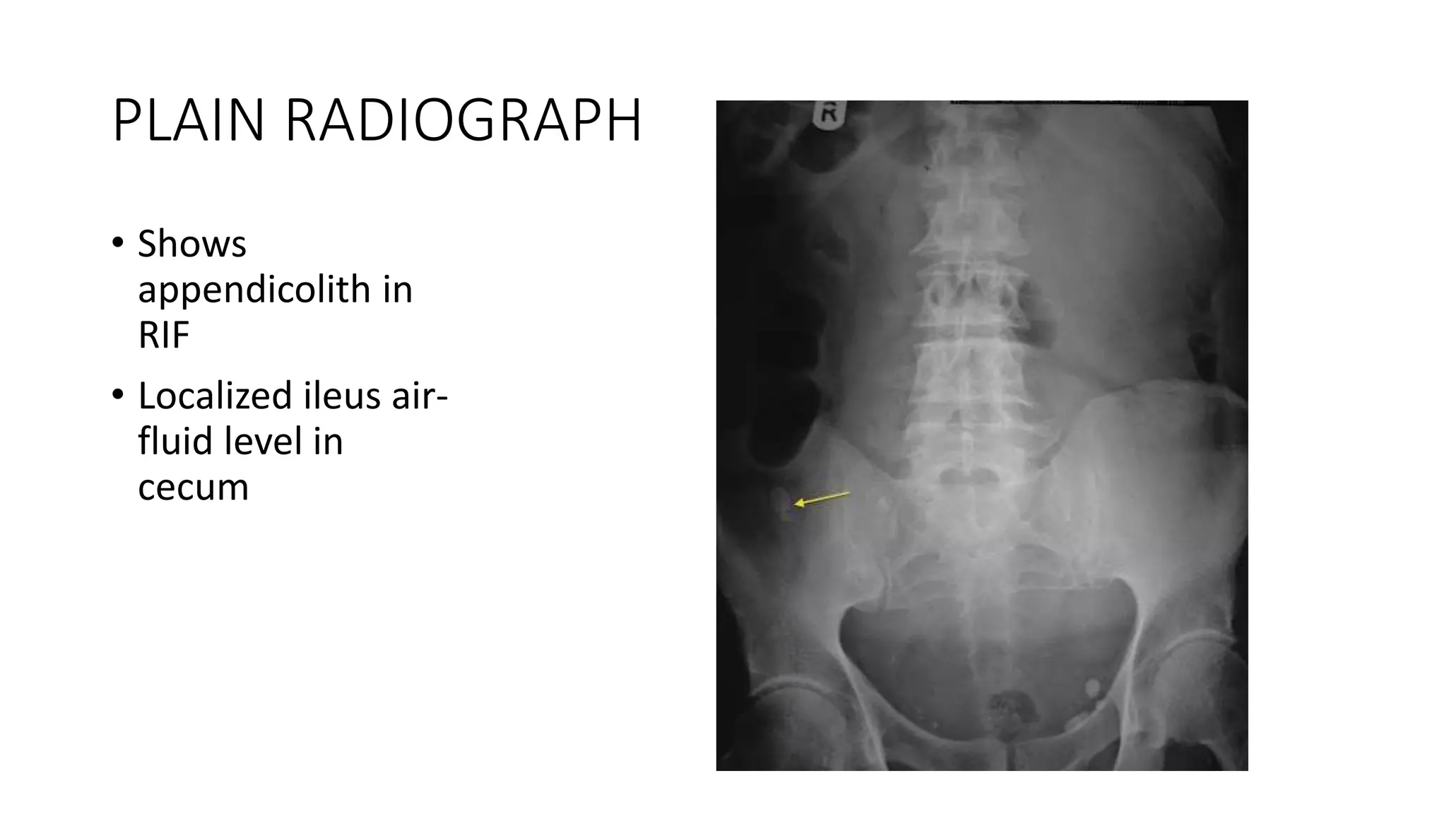 Acute abdomen | PPTX