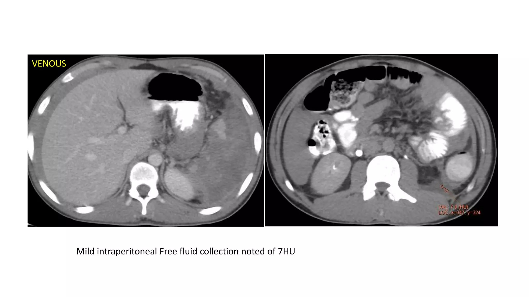 Acute abdomen | PPTX