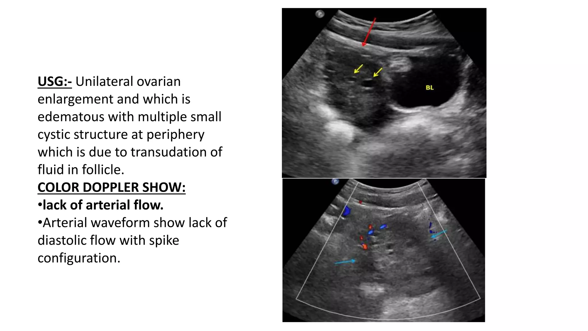 Acute abdomen | PPTX