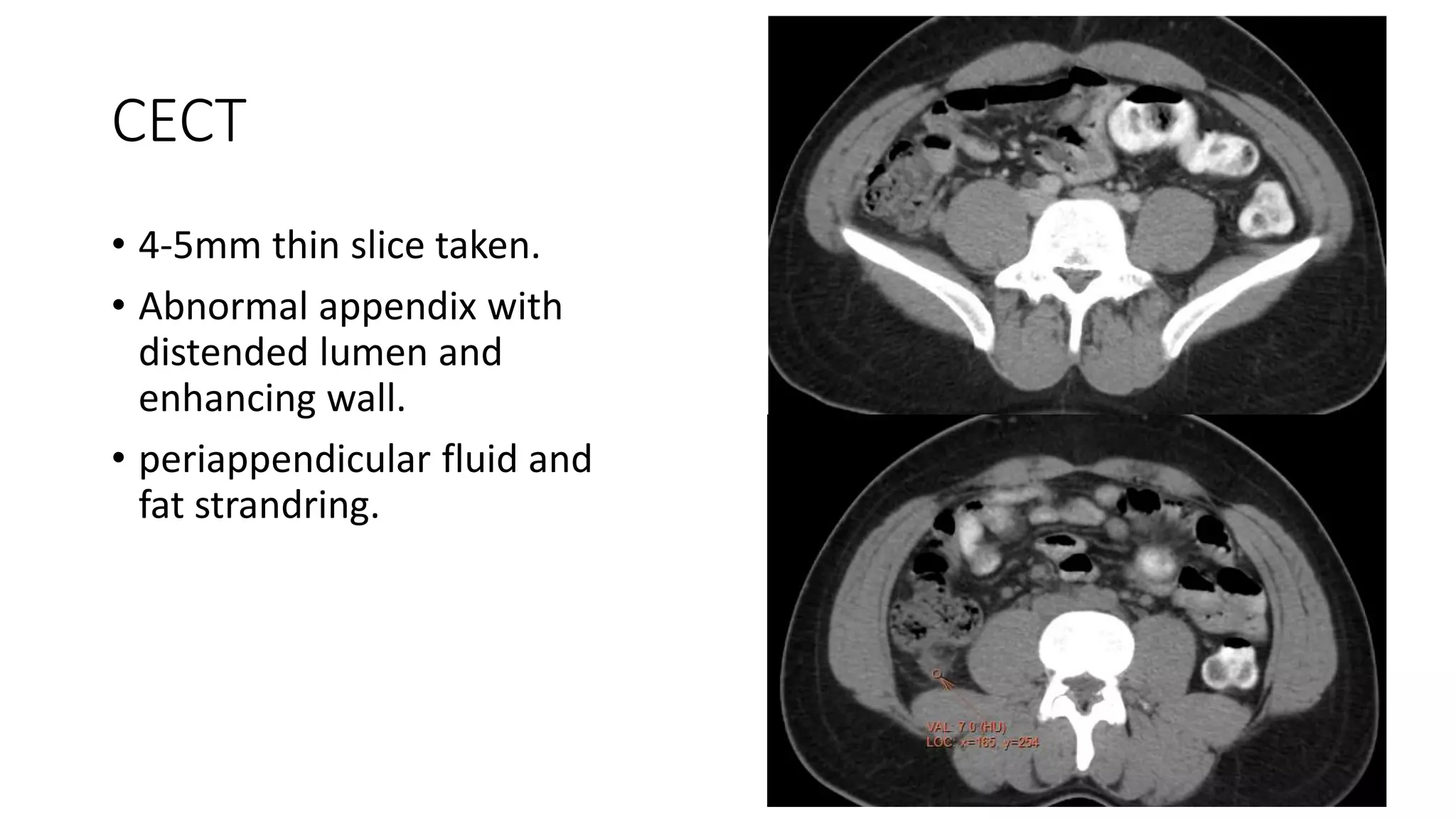 Acute abdomen | PPTX