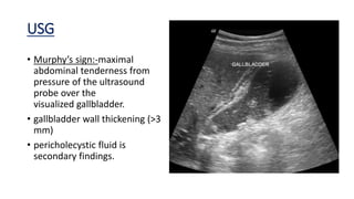Acute abdomen | PPTX