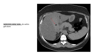 Acute abdomen | PPTX