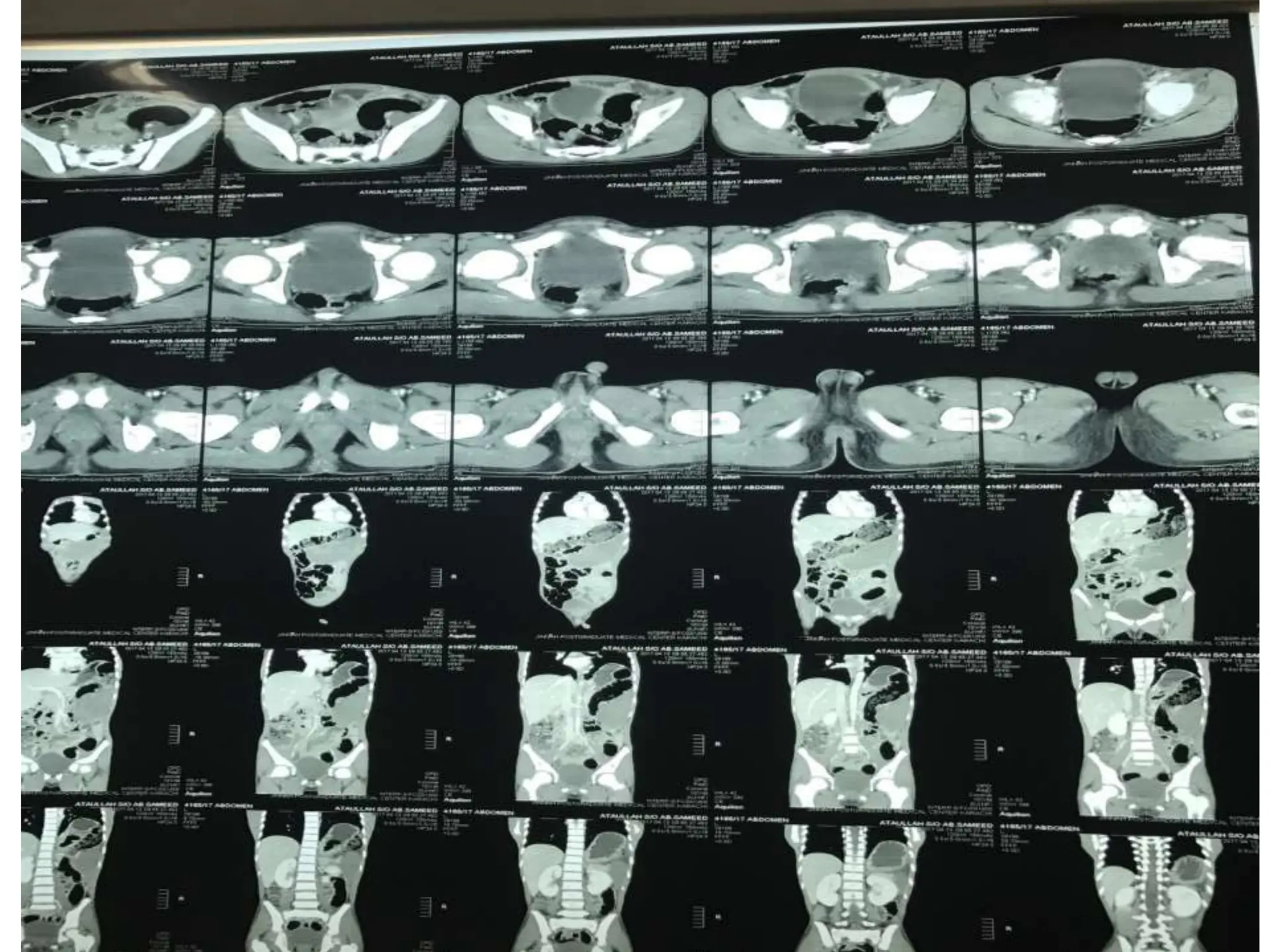 Ward case of Acute Abdomen without complication | PPTX