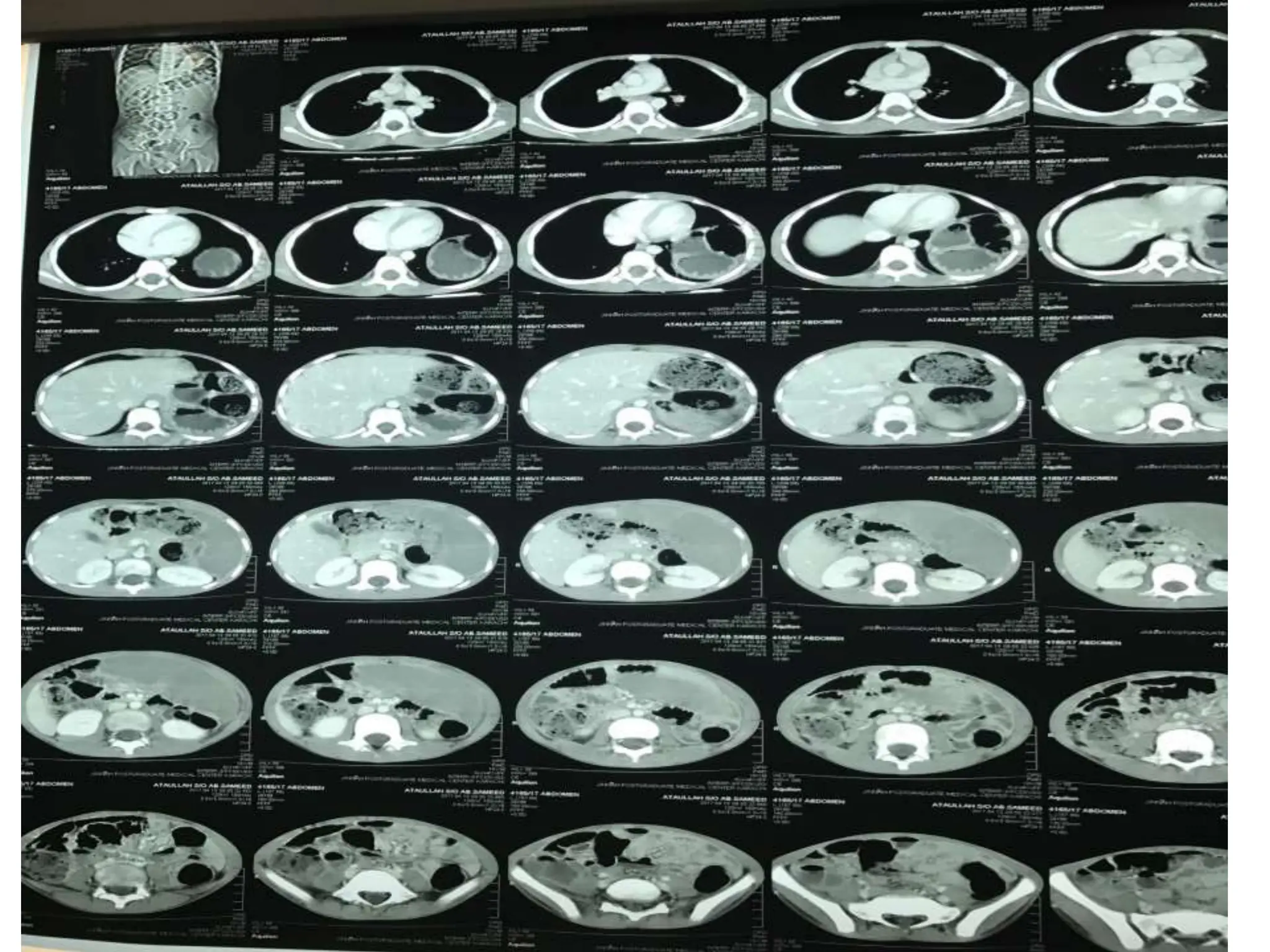 Ward case of Acute Abdomen without complication | PPTX