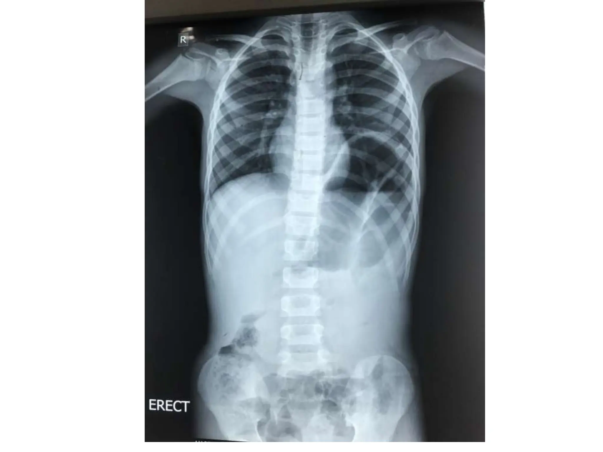 Ward case of Acute Abdomen without complication | PPTX