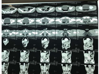 Ward case of Acute Abdomen without complication | PPTX