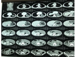 Ward case of Acute Abdomen without complication | PPTX