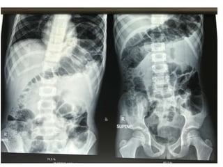 Ward case of Acute Abdomen without complication | PPTX