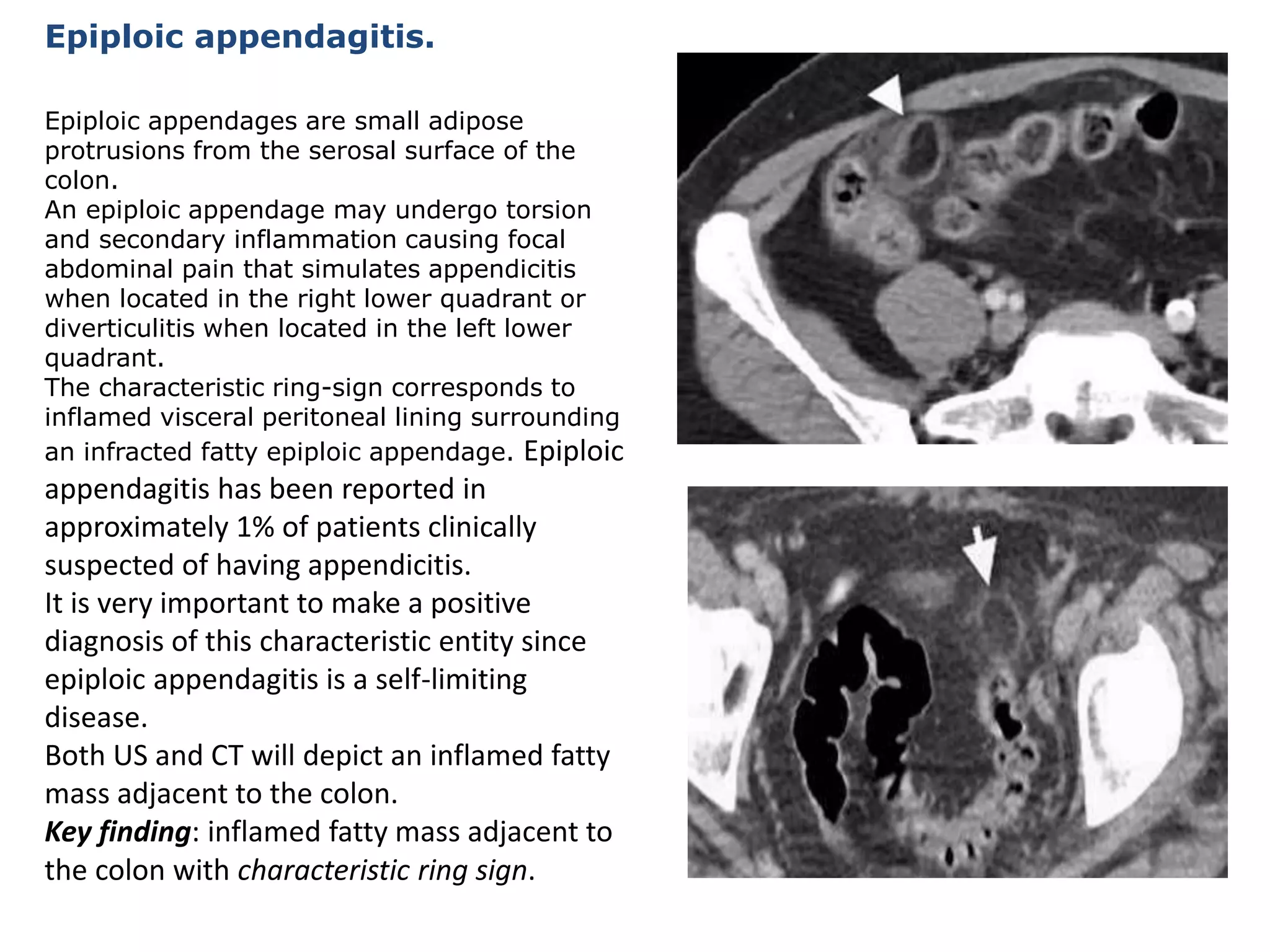 Acute abdomen a practical approach | PPTX