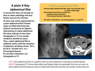 Acute abdomen a practical approach | PPTX