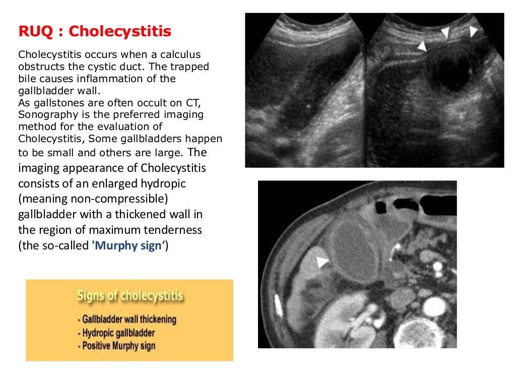 Acute Abdomen A Practical Approach
